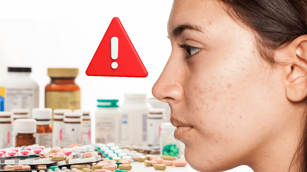 The Acne Drug Controversy: New Safety Measures Incoming