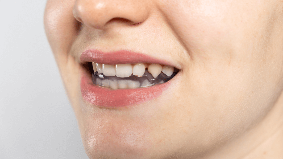 Bruxism, Biting Down On The Facts