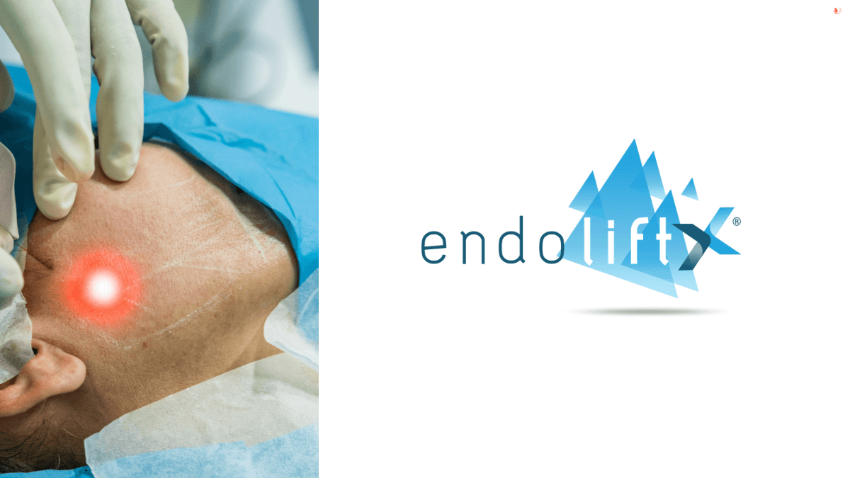 Endolift: Best Treatment For Skin Tightening & Fat Reduction