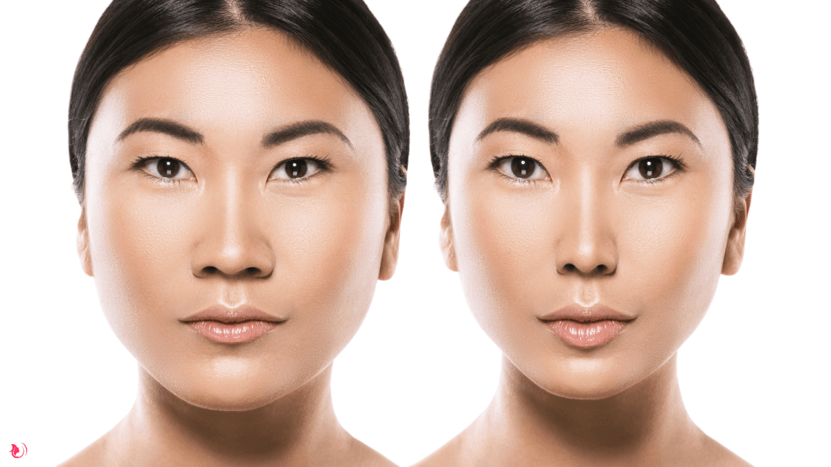 Jawline Perfection With Fillers & Cosmetic Treatments