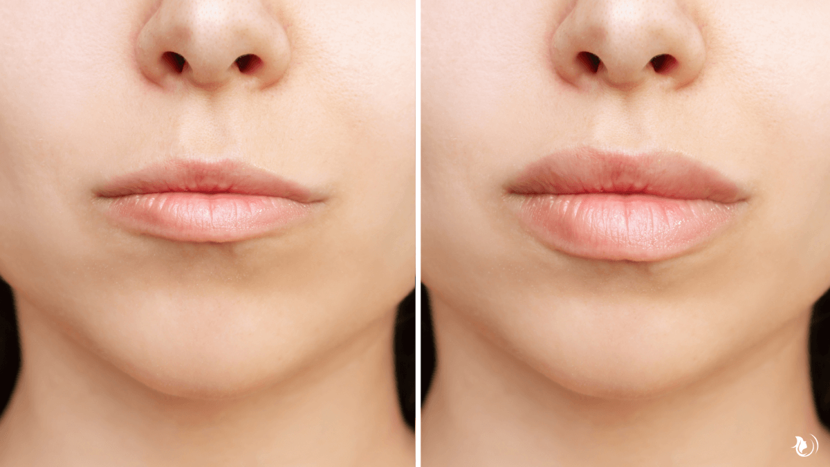 Lip Augmentation: The Art & Science Of Bigger Lips