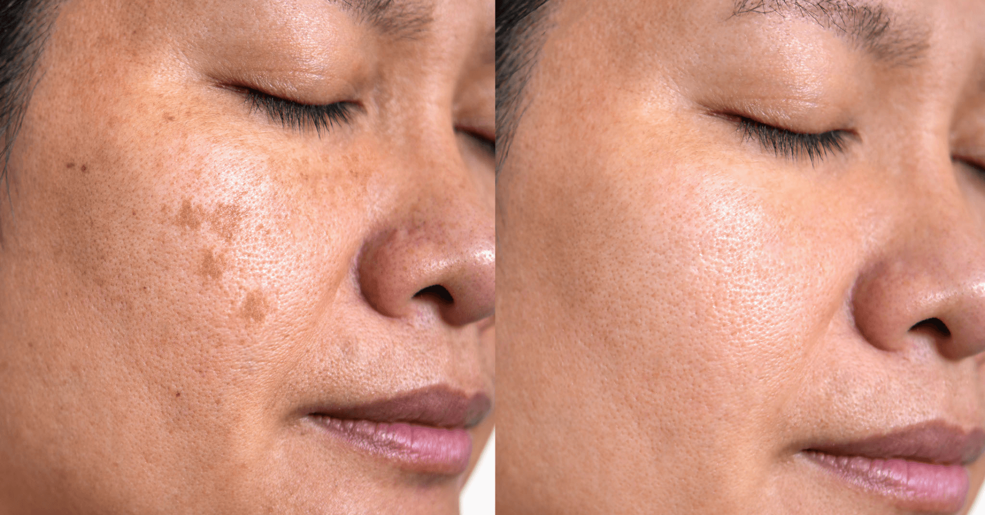 The Best Pigmentation Facials For You - Aesthetics Today