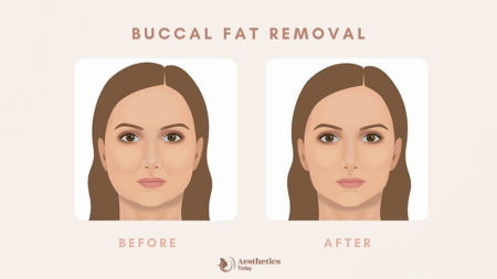 Buccal Fat Removal: Celebrity Cheek Slimming Secret