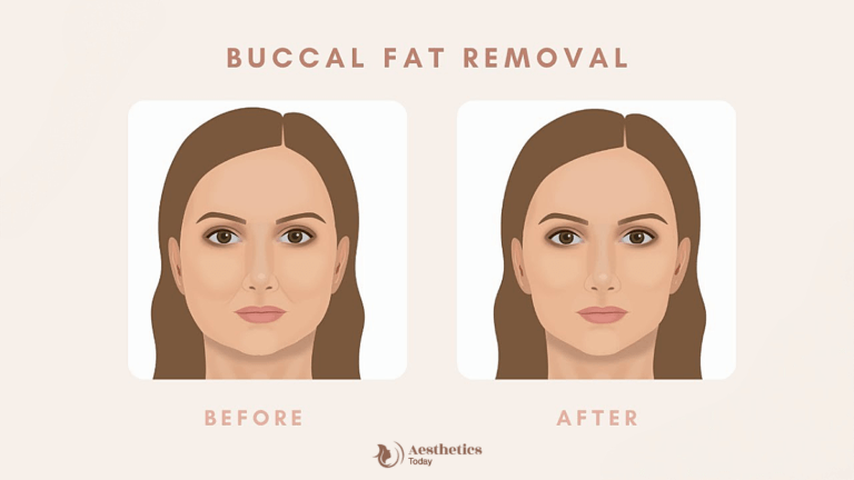 Buccal Fat Removal: Celebrity Cheek Slimming Secret