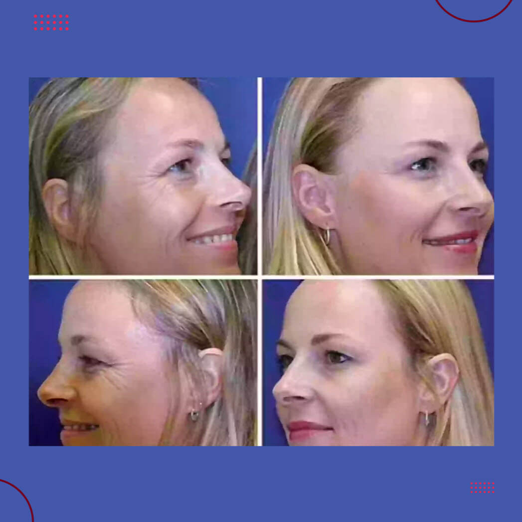 They’re Twins. One Used Botox For 20 Years. The Difference?