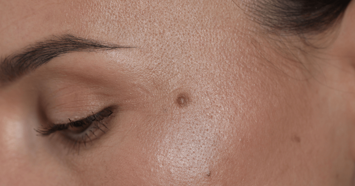 Get Rid Of Skin Lumps And Bumps With These Treatments